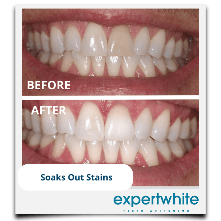 Teeth Whitening Products To Whiten Teeth At Home | Safest Gel & Kit