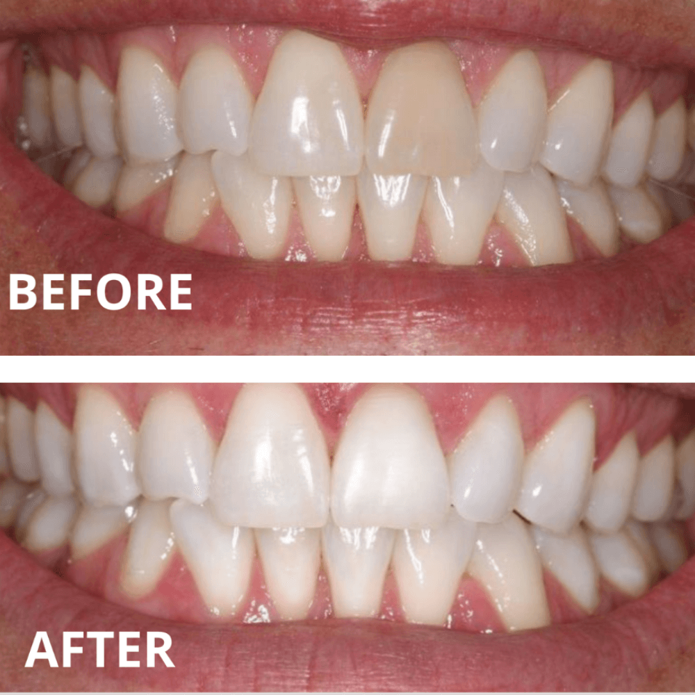 Expertwhite 44 Strongest Teeth Whitening Gel For Trays | Made USA