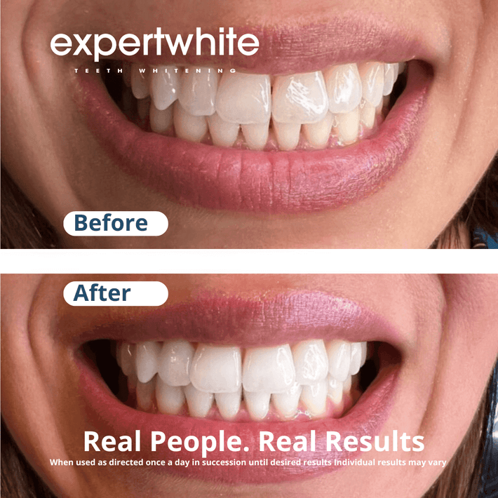 Teeth Whitening Products To Whiten Teeth At Home | Safest Gel & Kit